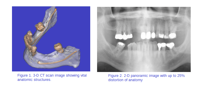 computer-guided-dental-implant-placement | Stanwood Dentist